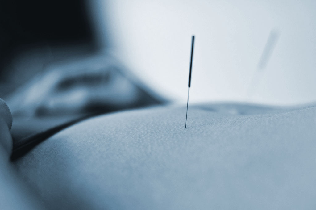 Flickr_acupuncture_CC.jpg | PhysioQinetics